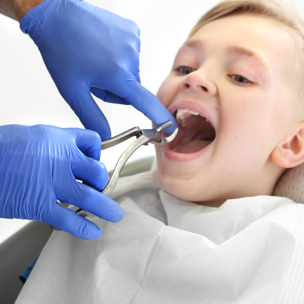 Tooth Extractions in Houston, TX | Next Care Dental Houston